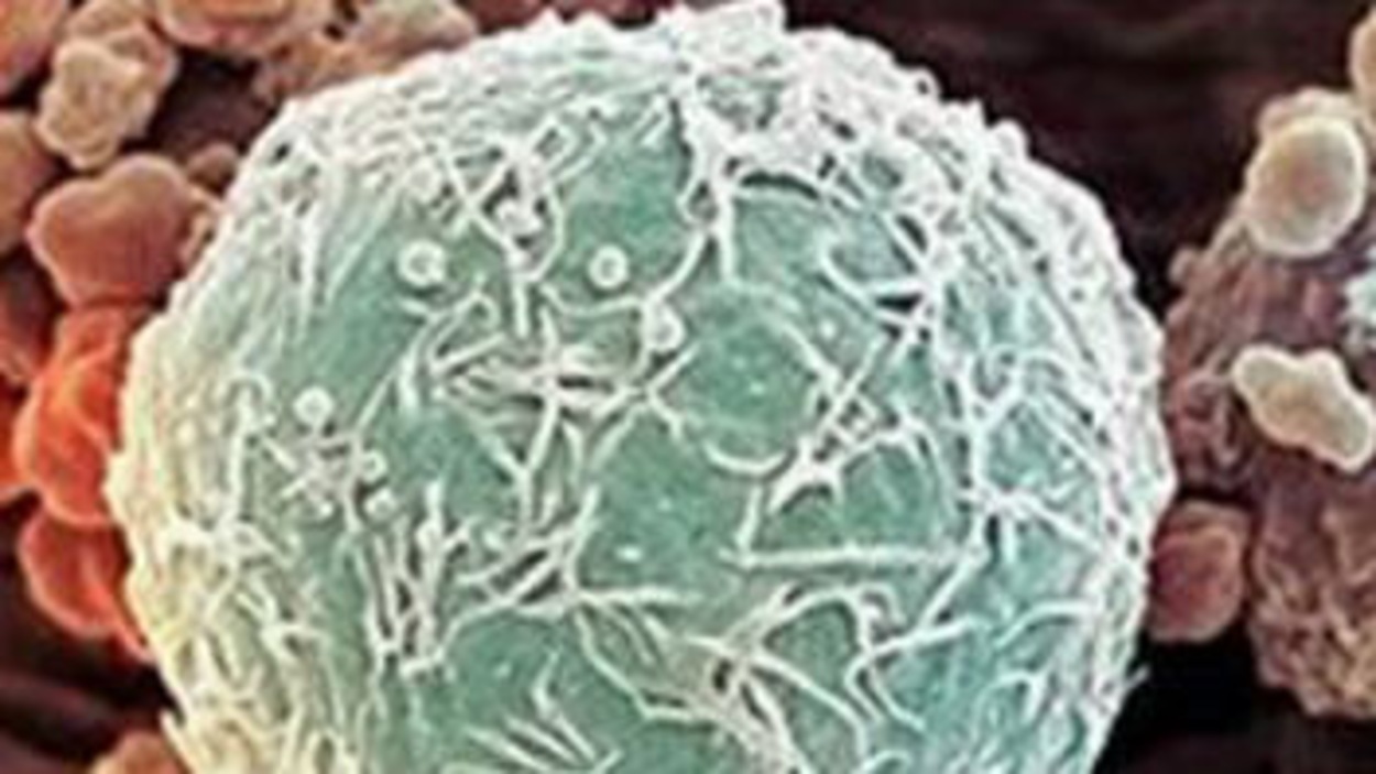 Découverte d'une mutation génique déterminante dans un type de cancer ...