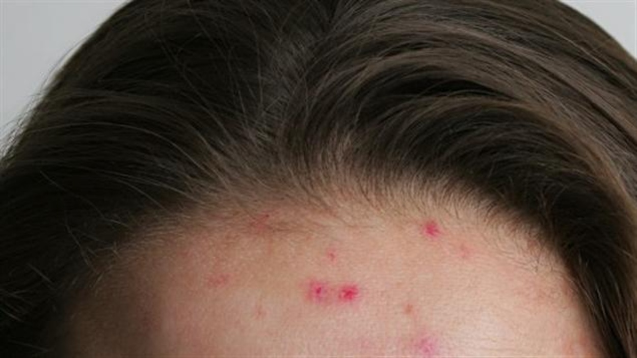 Tactuo, une nouvelle arme contre l'acné | Radio-Canada