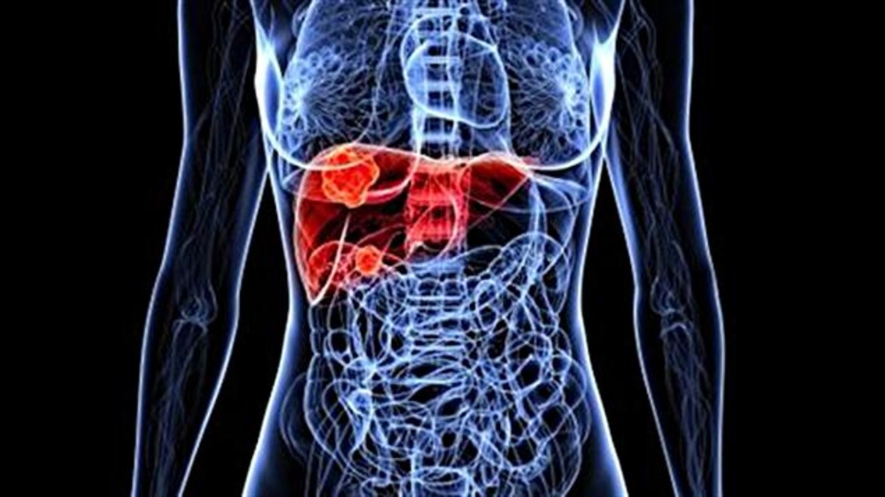 Cancer du foie : le rôle de l'hépatite C se précise | Radio-Canada