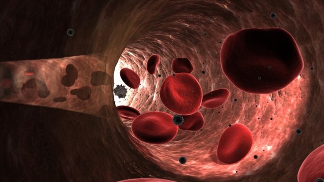 Angioplastie : Un médicament réduit les dommages au coeur | Radio-Canada