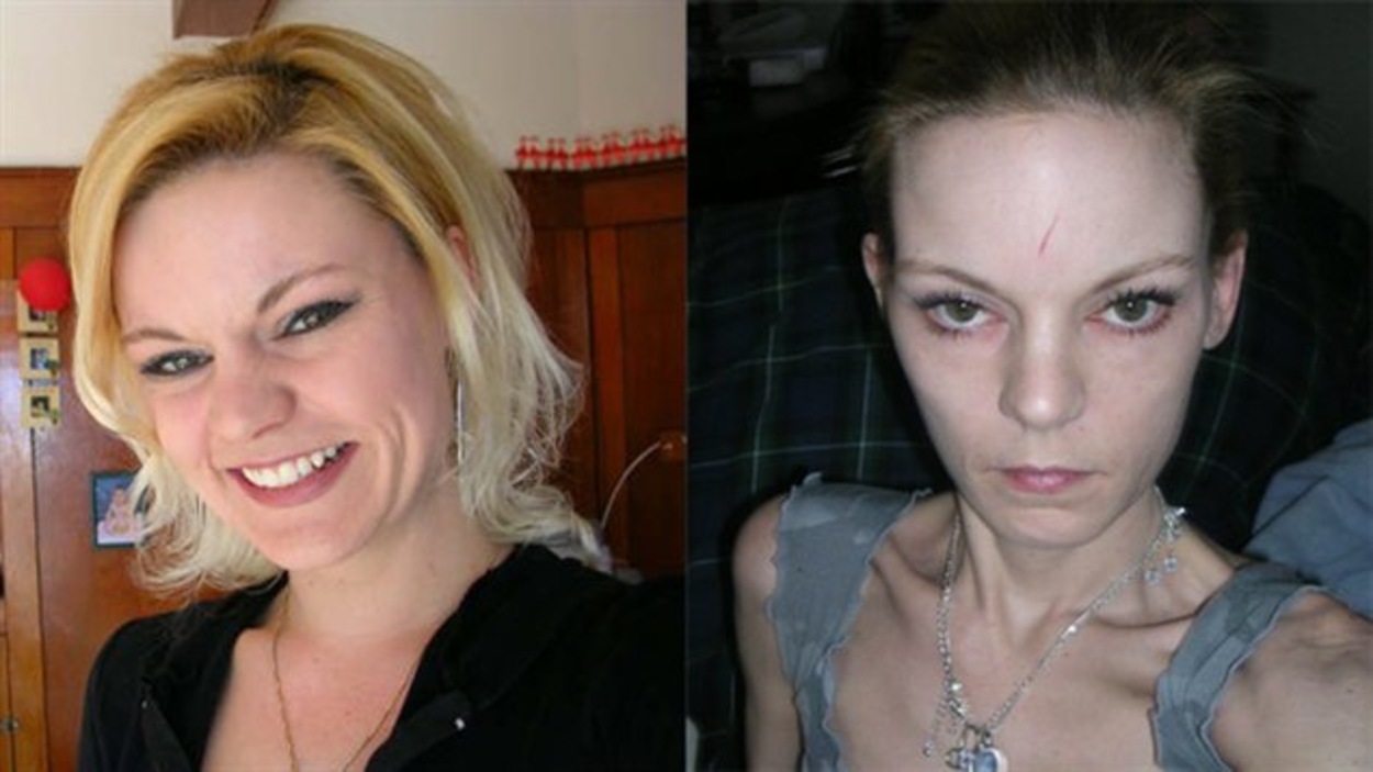 Une patiente anorexique de C.-B. soignée en Alberta | Radio-Canada