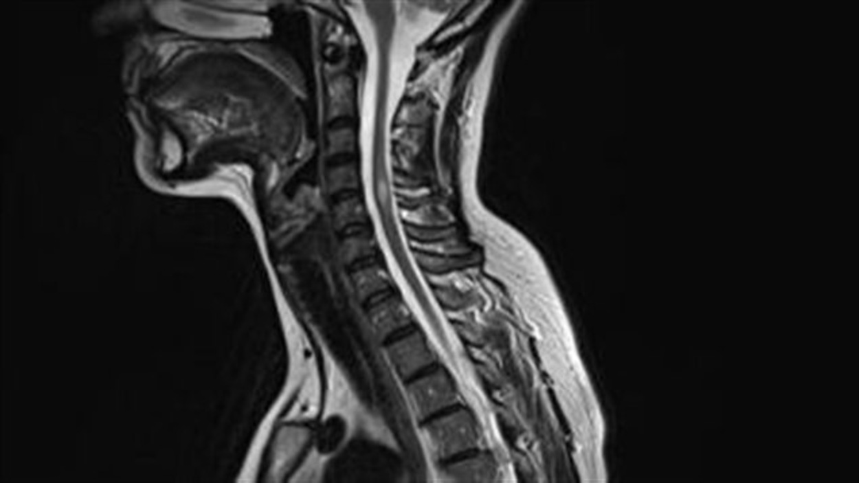 La sclérose en plaques : percée québécoise | Radio-Canada