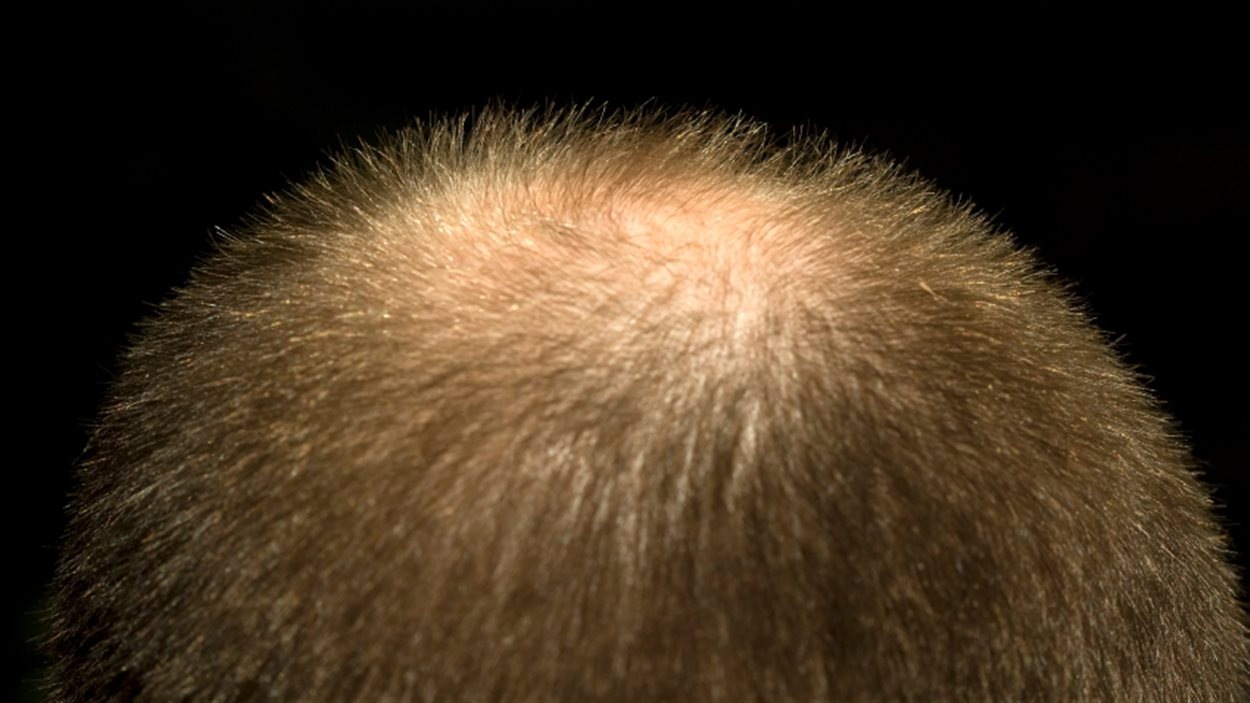 Calvitie : à quelques cheveux d'un traitement? | Radio-Canada