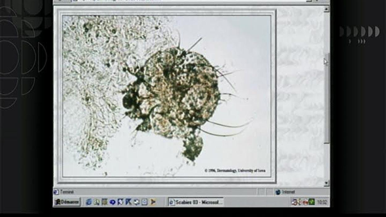 Éclosion de gale à l'hôpital Halifax Infirmary | Radio-Canada