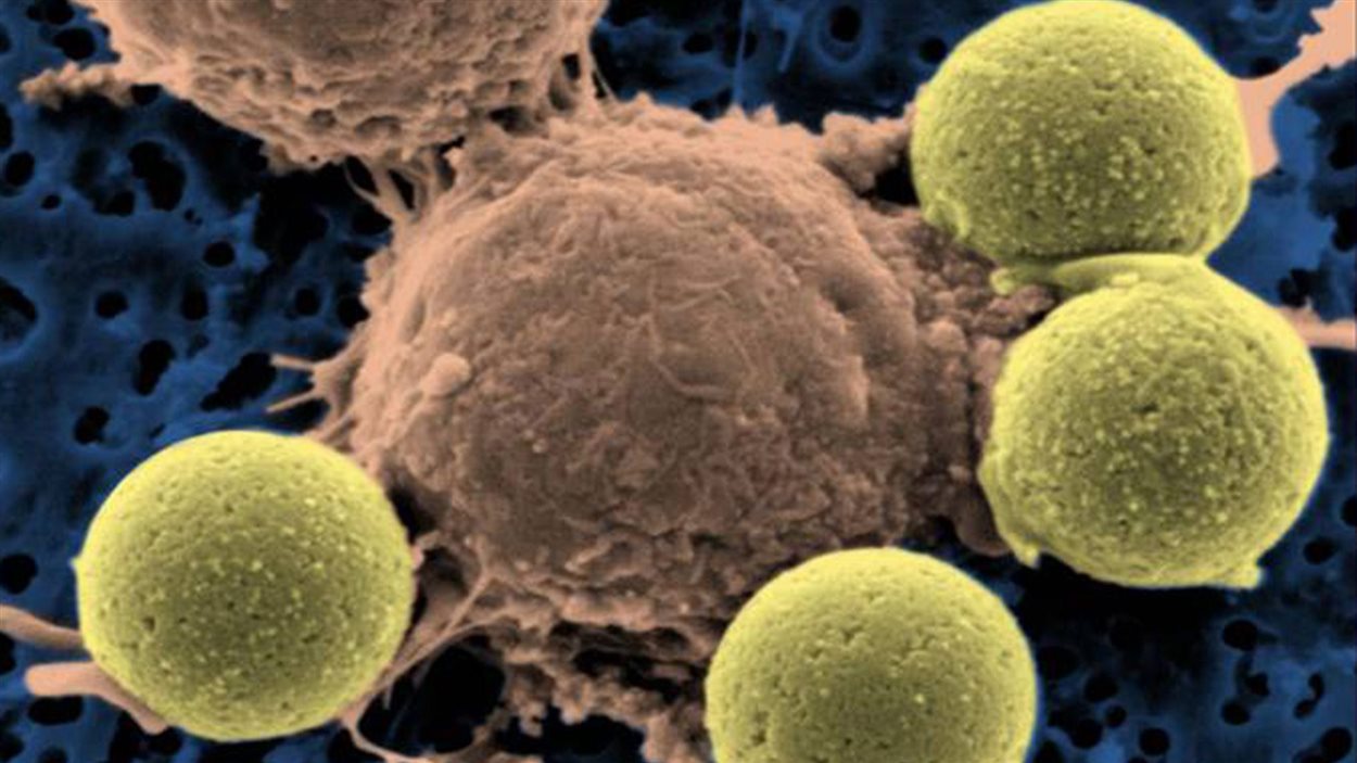 Percée canadienne dans le traitement de la leucémie | Radio-Canada