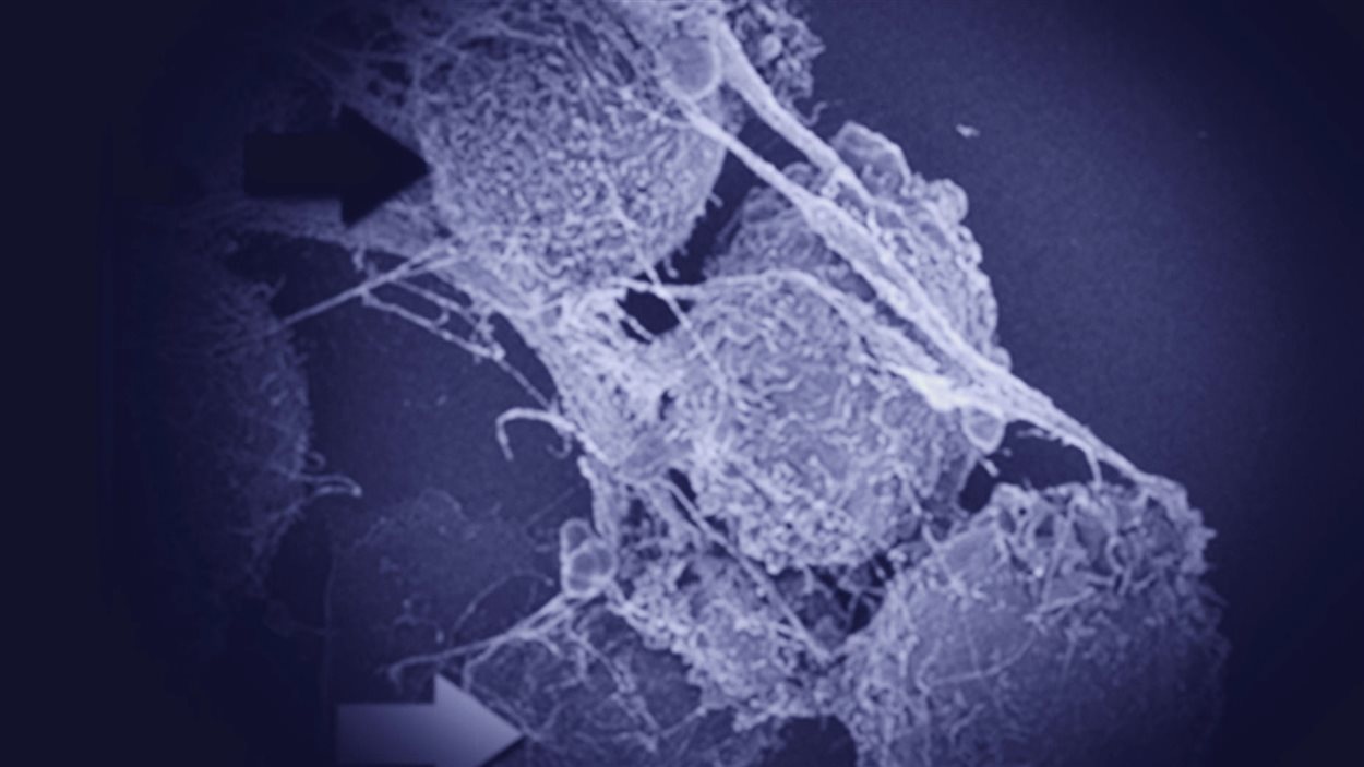 Infections et cellules cancéreuses : un dangereux mélange | Radio-Canada