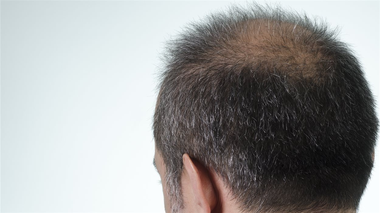Calvitie : une nouvelle technique de greffe prometteuse | Radio-Canada