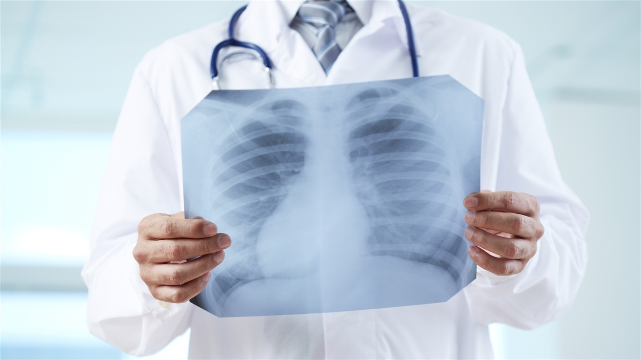 Dépistage du cancer du poumon : les rayons X remis en question | Radio ...